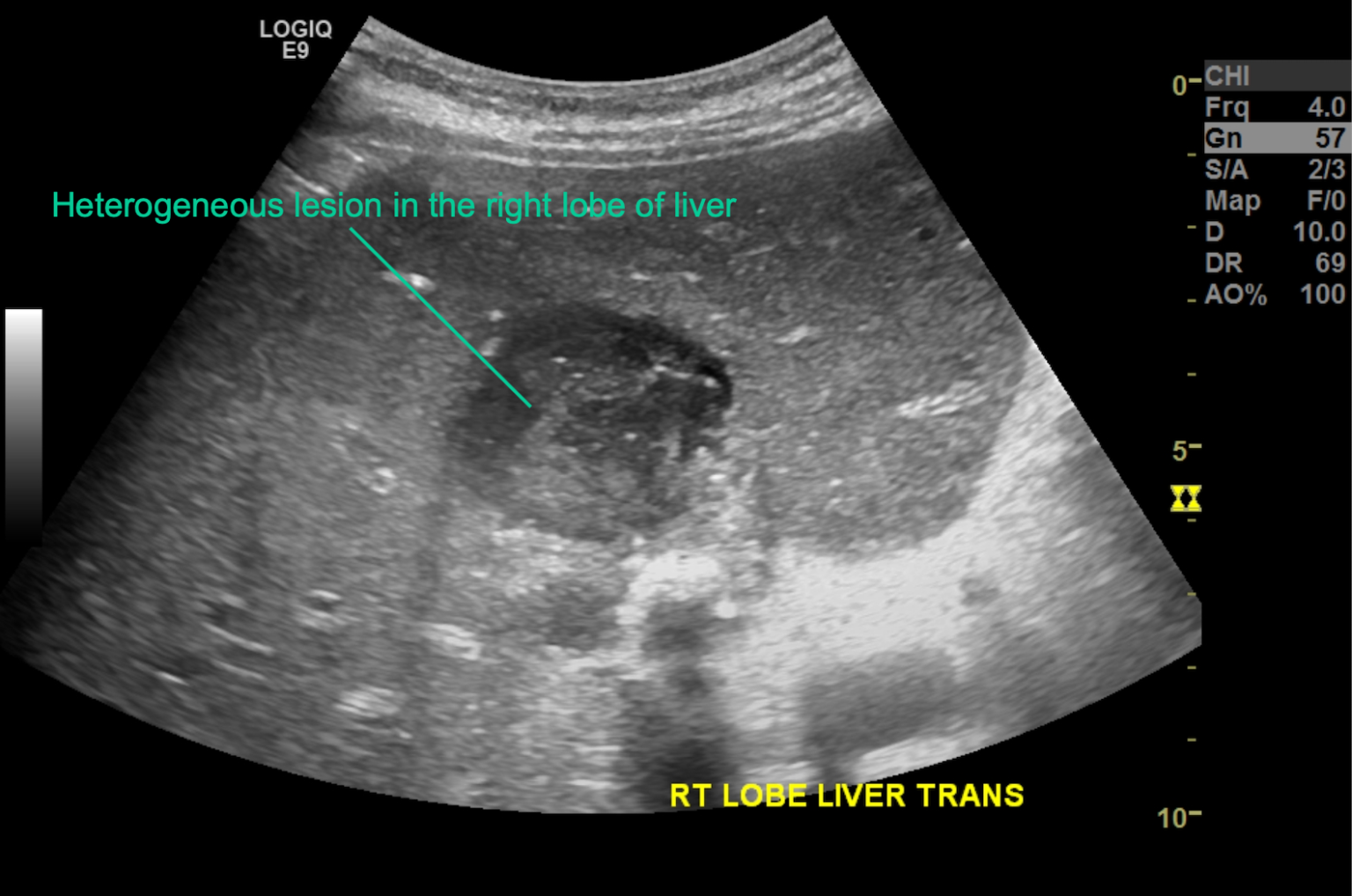 CT Case 081 • LITFL • CT scan interpretation