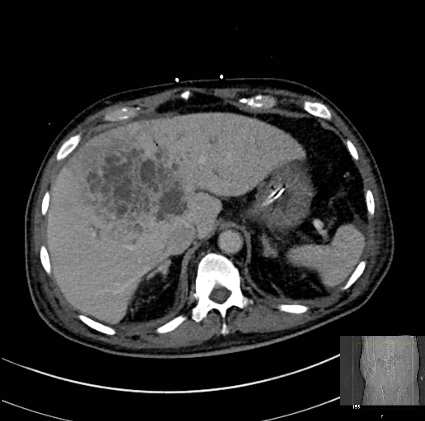 CT Case 081 • LITFL • CT scan interpretation