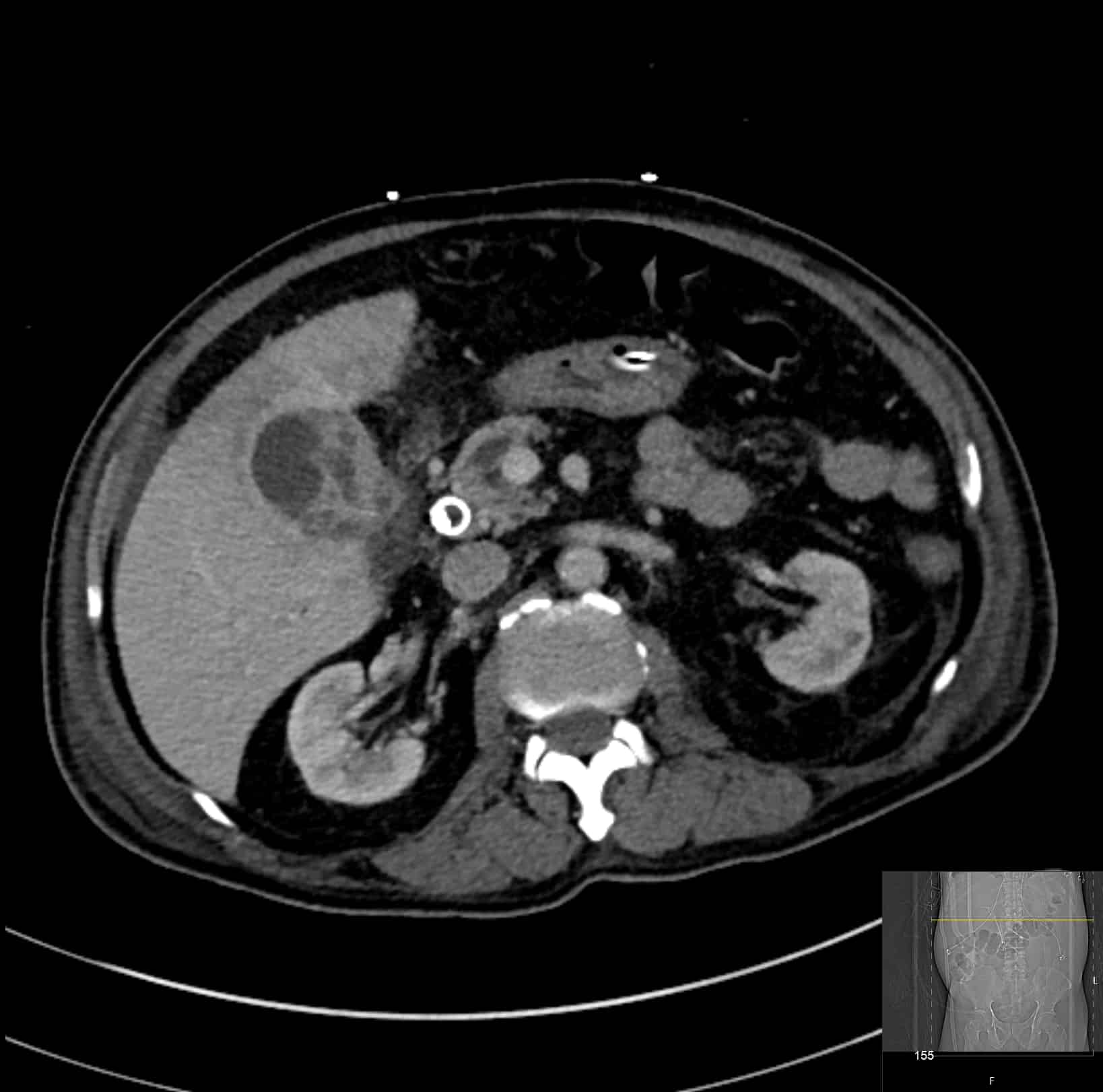 CT Case 081 • LITFL • CT scan interpretation