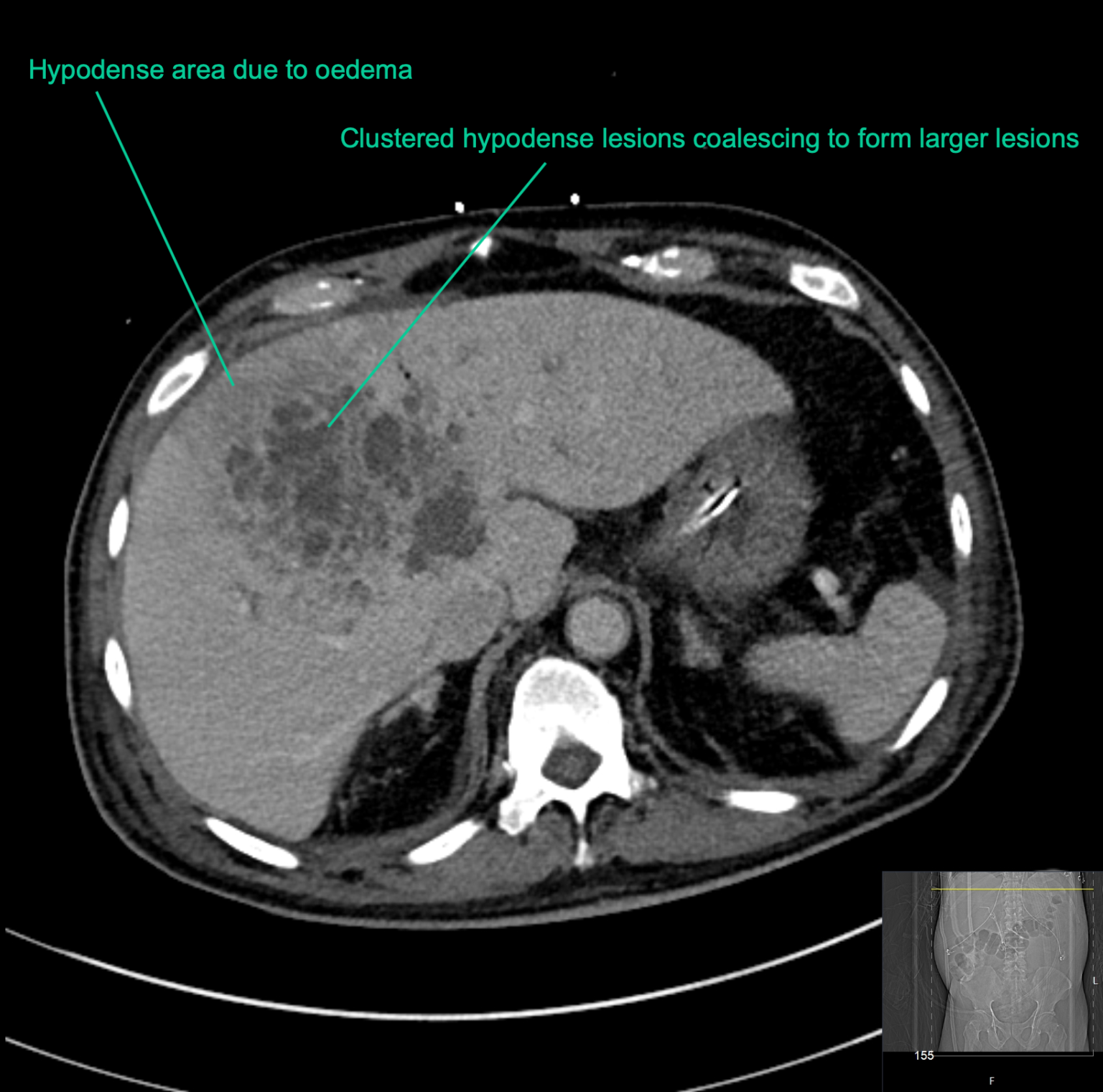 CT Case 081 • LITFL • CT scan interpretation