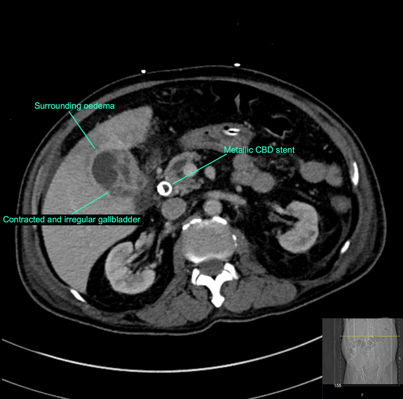 CT Case 081 • LITFL • CT scan interpretation