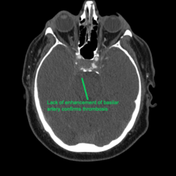 CT Case 083 • LITFL • CT scan interpretation