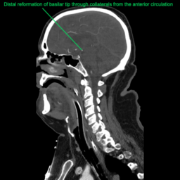 CT Case 083 • LITFL • CT scan interpretation