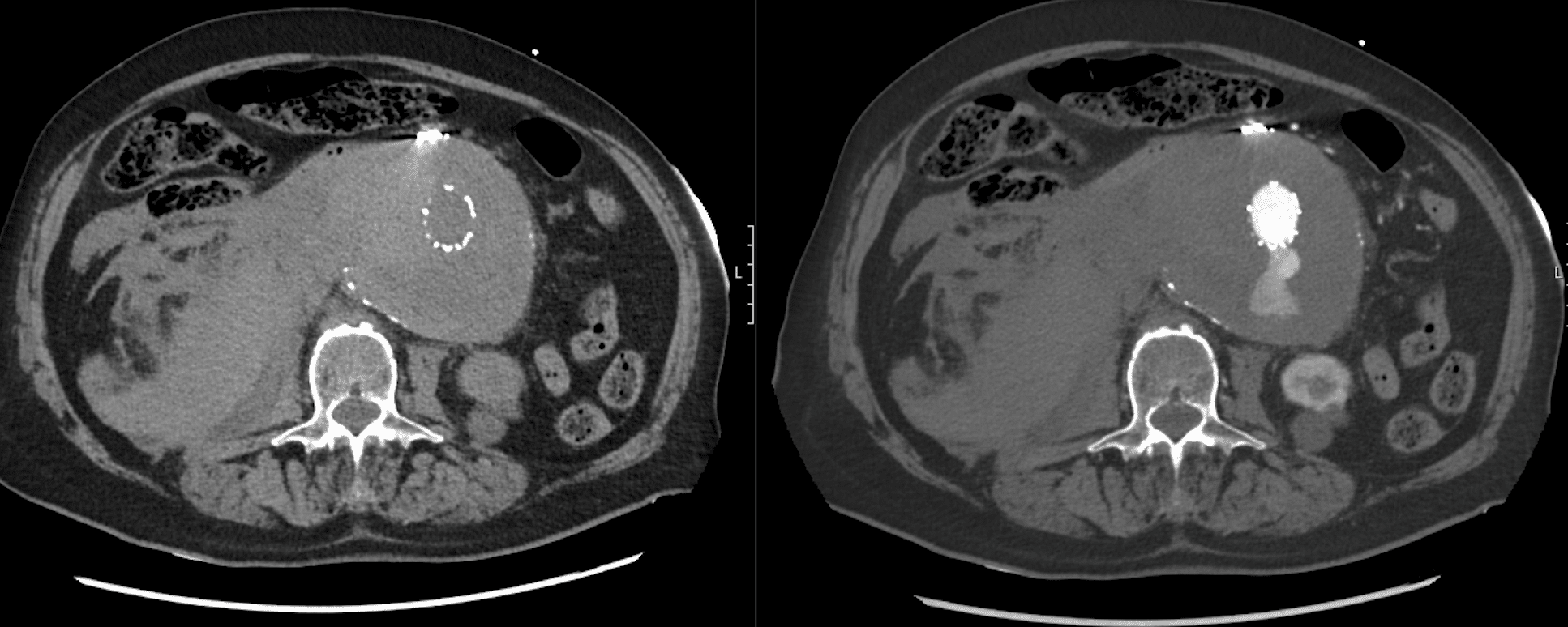 CT Case 084 • LITFL • CT scan interpretation