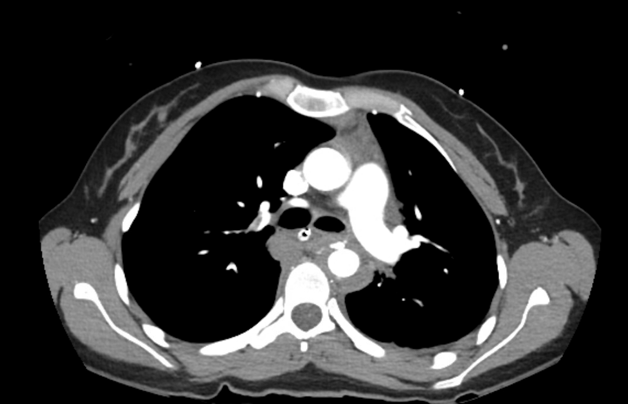 CT Case 085 • LITFL • CT scan interpretation
