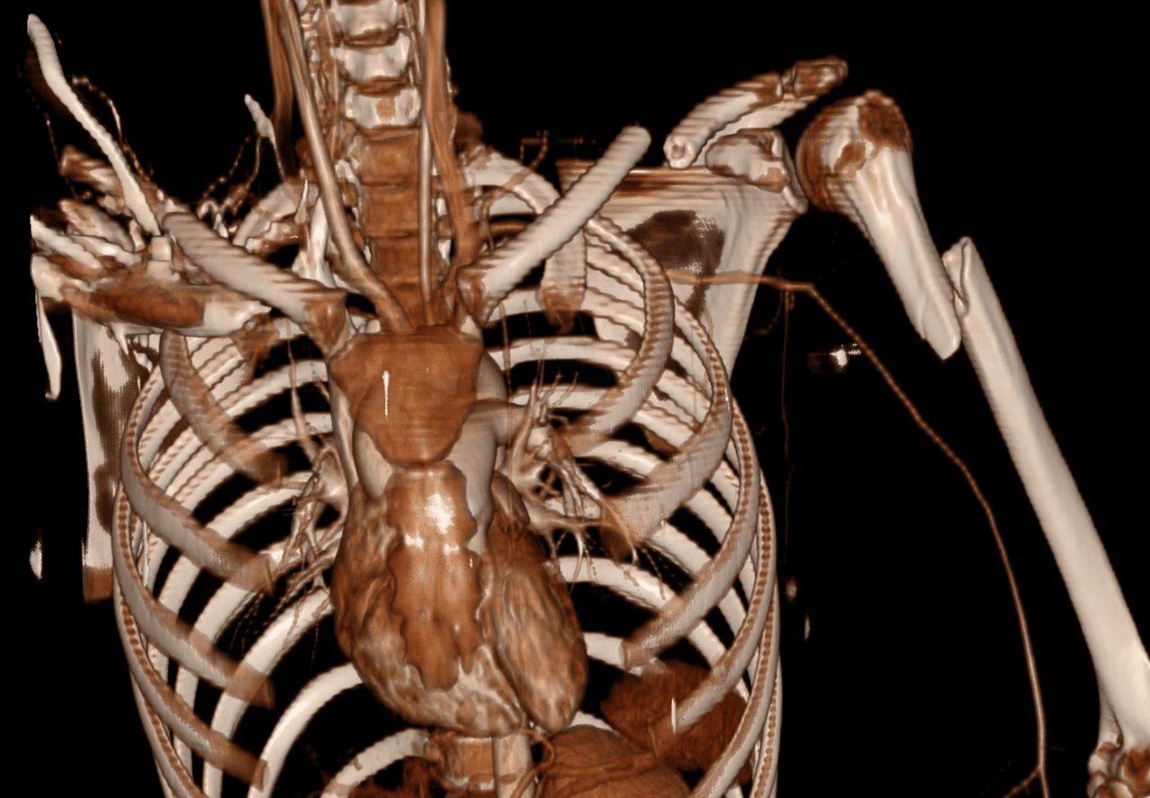 CT Case 086 • LITFL • CT scan interpretation