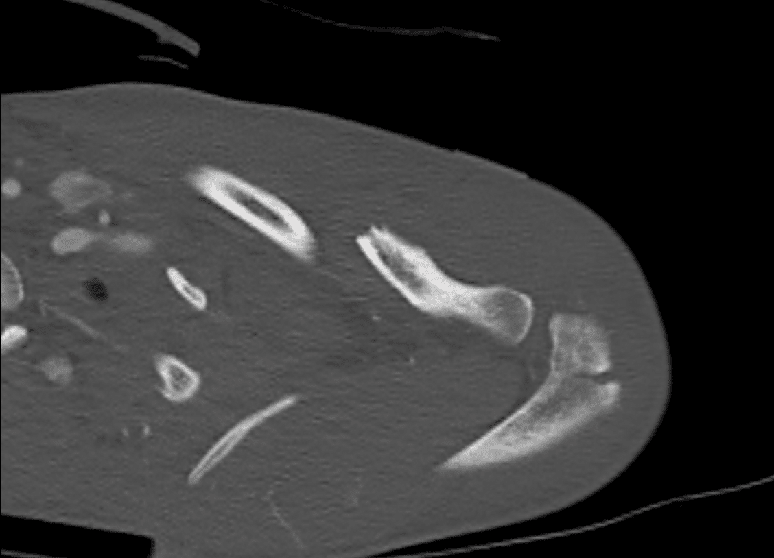CT Case 086 • LITFL • CT scan interpretation