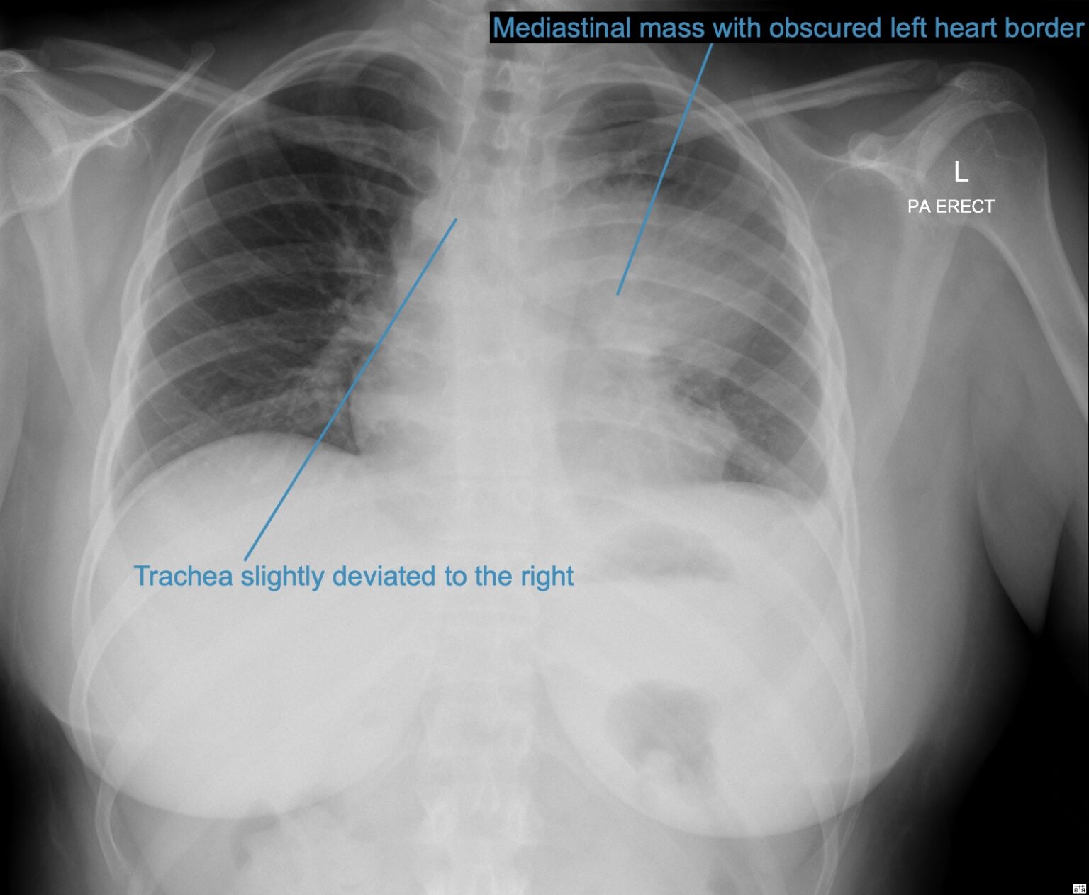 CT Case 087 • LITFL • CT scan interpretation
