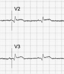 Activate or Wait - 006 • LITFL • Top 100 ECG