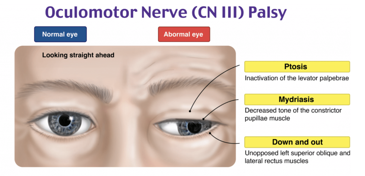 Third Cranial Nerve Lesions • LITFL • FFS