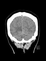 CT Case 091 • LITFL • CT scan interpretation