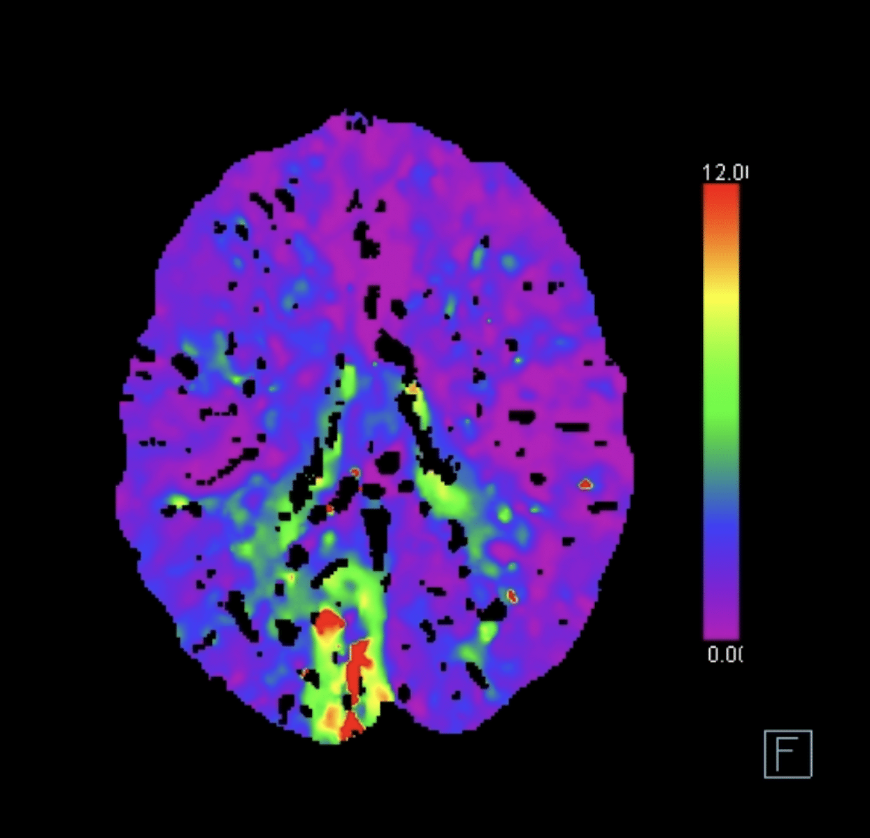 CT Case 091 • LITFL • CT scan interpretation
