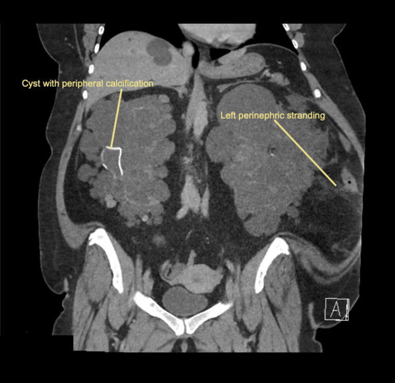 CT Case 090 • LITFL • CT scan interpretation