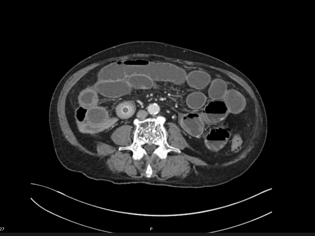 CT Case 092 • LITFL • CT scan interpretation