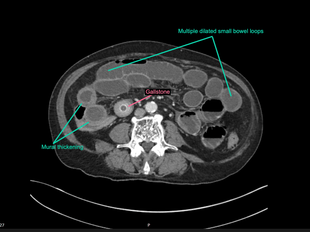 CT Case 092 • LITFL • CT scan interpretation