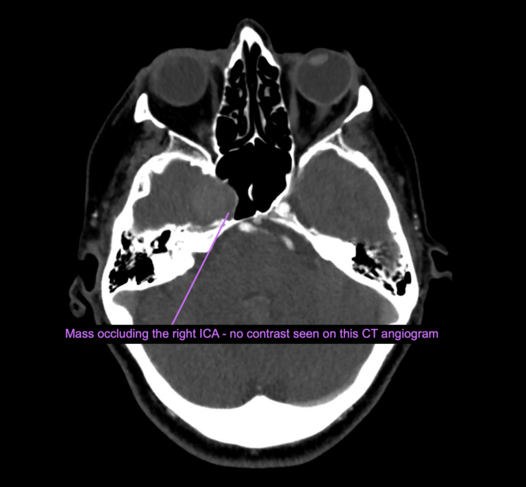 CT Case 094 • LITFL • CT scan interpretation
