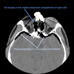CT Case 096 • LITFL • CT scan interpretation