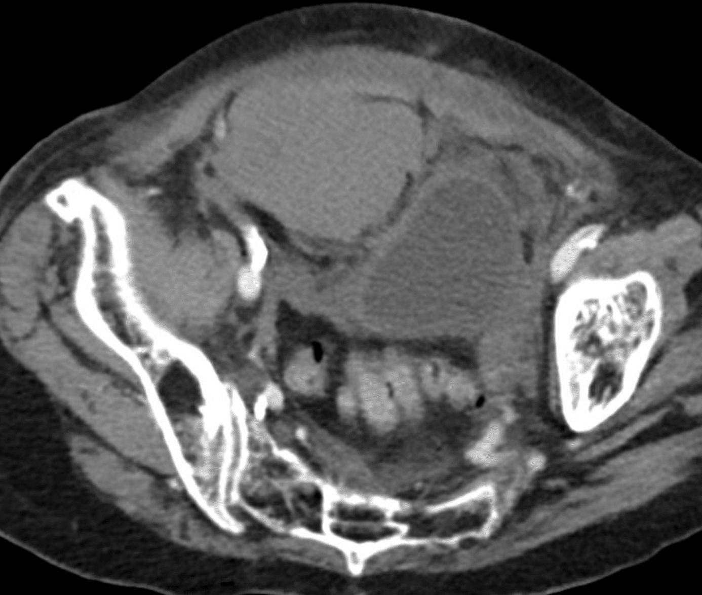 CT Case 097 • LITFL • CT scan interpretation
