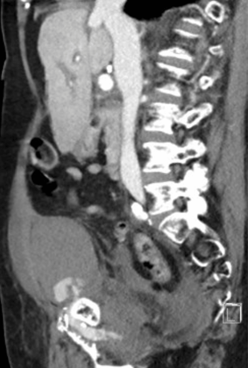 CT Case 097 • LITFL • CT scan interpretation