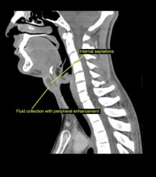 CT Case 099 • LITFL • CT scan interpretation