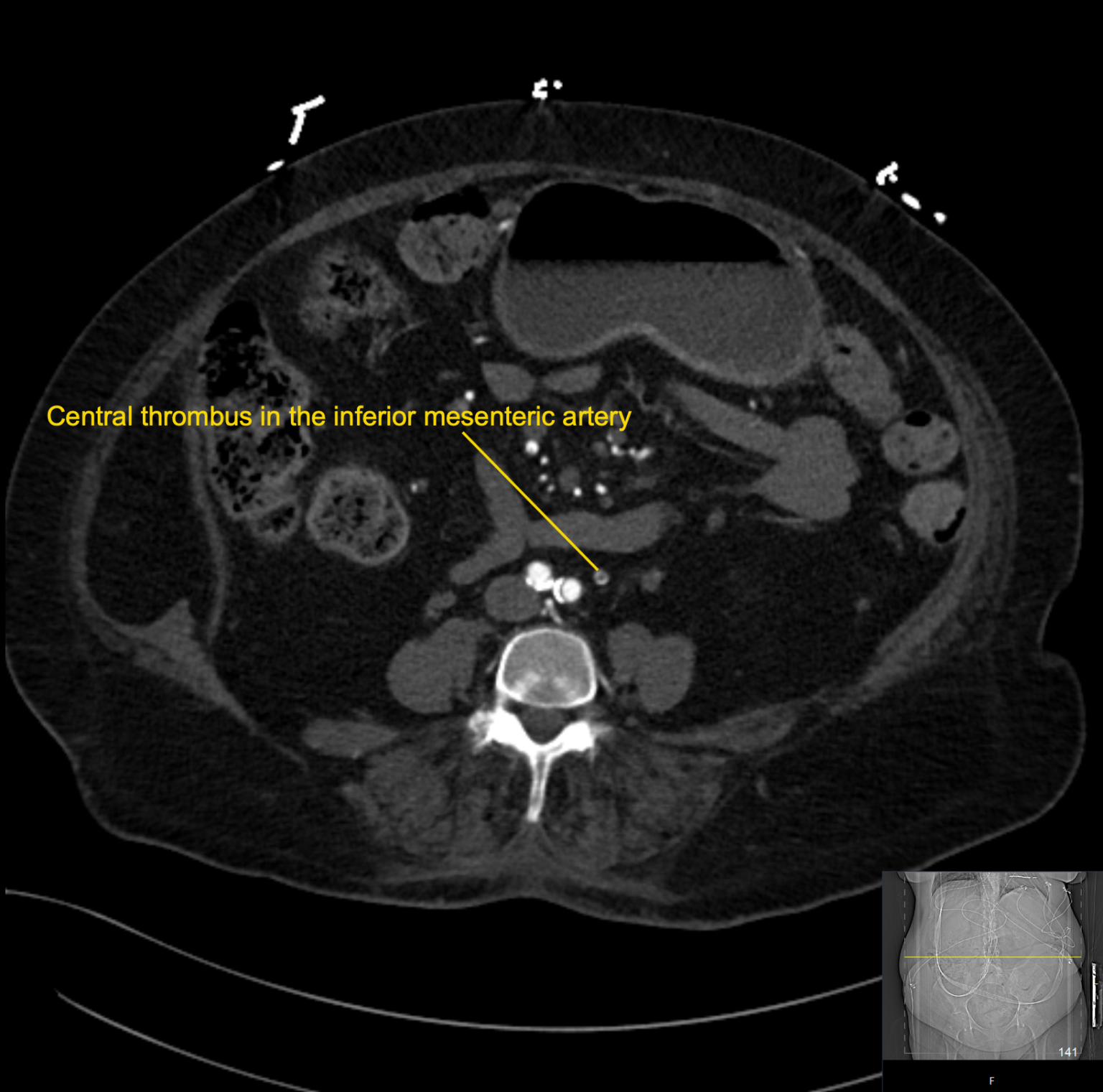 CT Case 100 • LITFL • CT scan interpretation