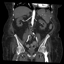 CT Case 100 • LITFL • CT scan interpretation