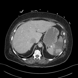 CT Case 100 • LITFL • CT scan interpretation