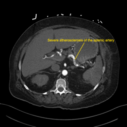 CT Case 100 • LITFL • CT scan interpretation