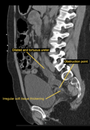 CT Case 101 • LITFL • CT scan interpretation