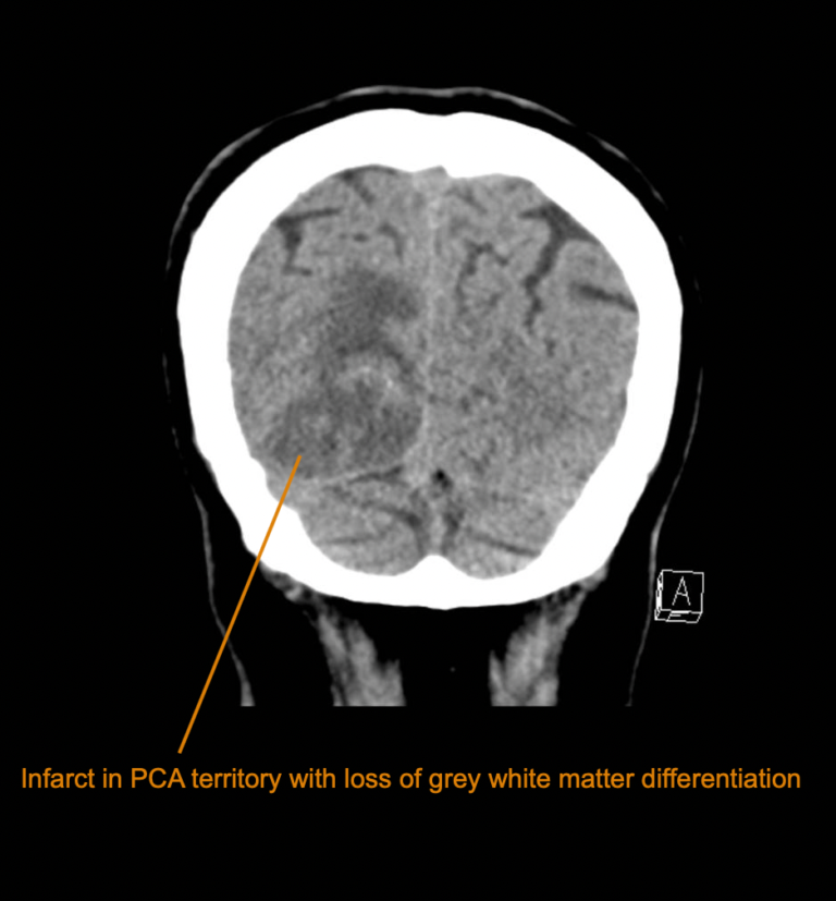 CT Case 089 • LITFL • CT scan interpretation