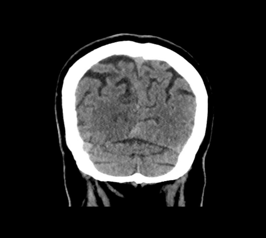 CT Case 089 • LITFL • CT scan interpretation
