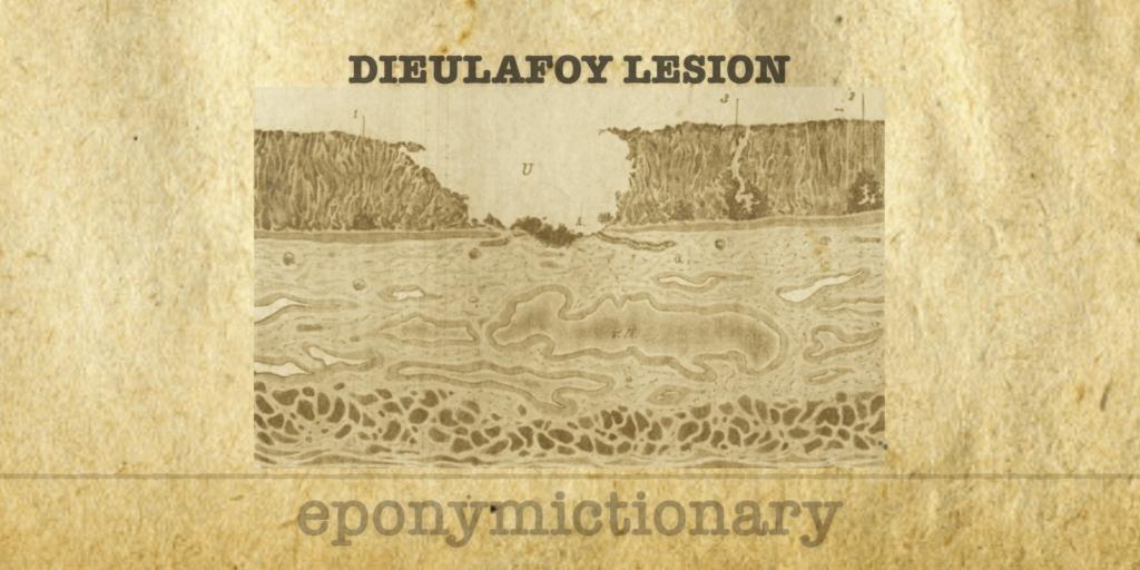 Dieulafoy Lesion • LITFL • Medical Eponym Lirbary