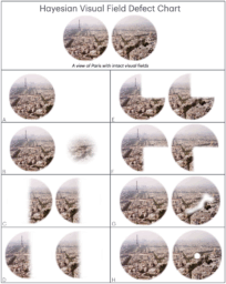 Second Cranial Nerve Lesions • LITFL • FFS