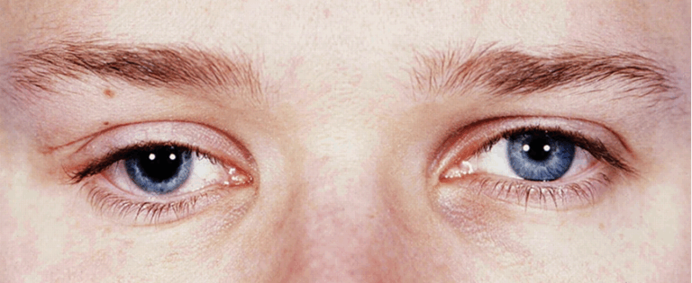 Third Cranial Nerve Lesions • LITFL • FFS