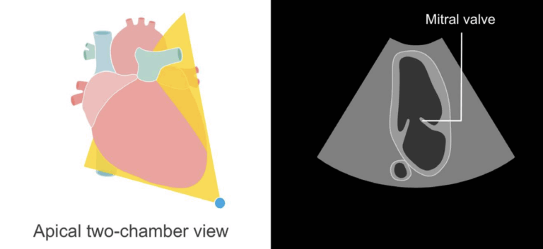 Echo basics: Valve Views • LITFL • Radiology Library