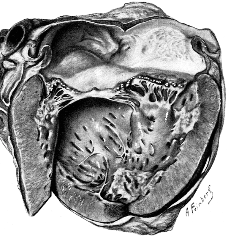 Emanuel Libman • LITFL • Medical Eponym Library