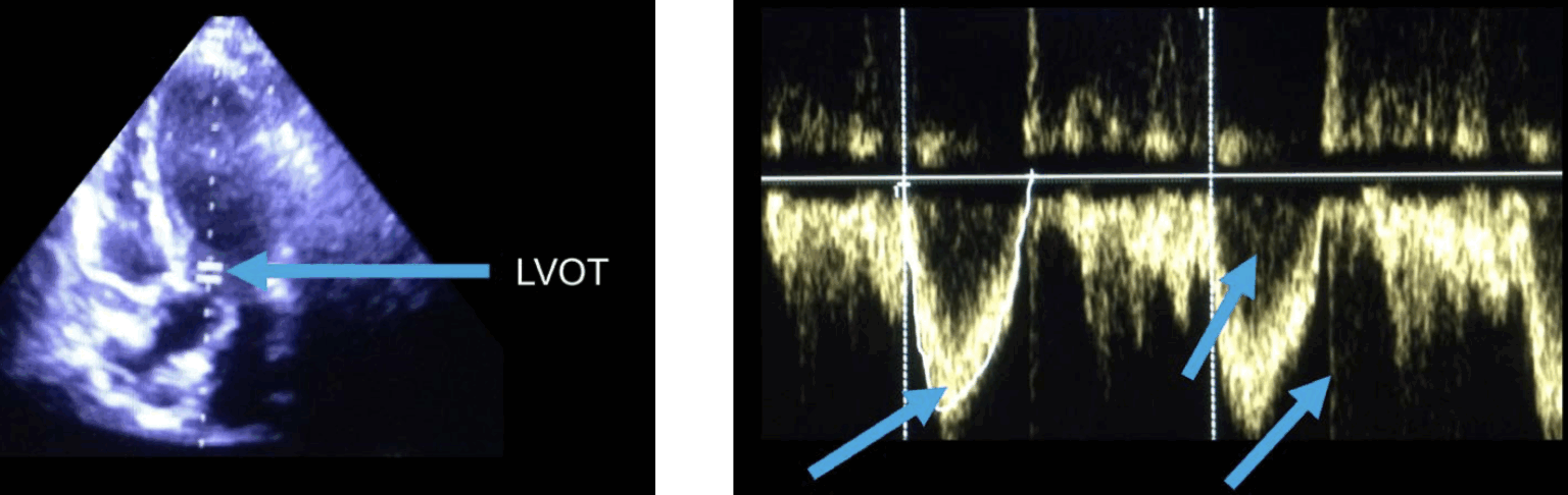 Echo basics: Measurements and Reports • LITFL • Radiology Library