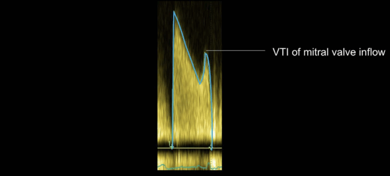 Echo basics: Aortic Regurgitation • LITFL • Radiology Library