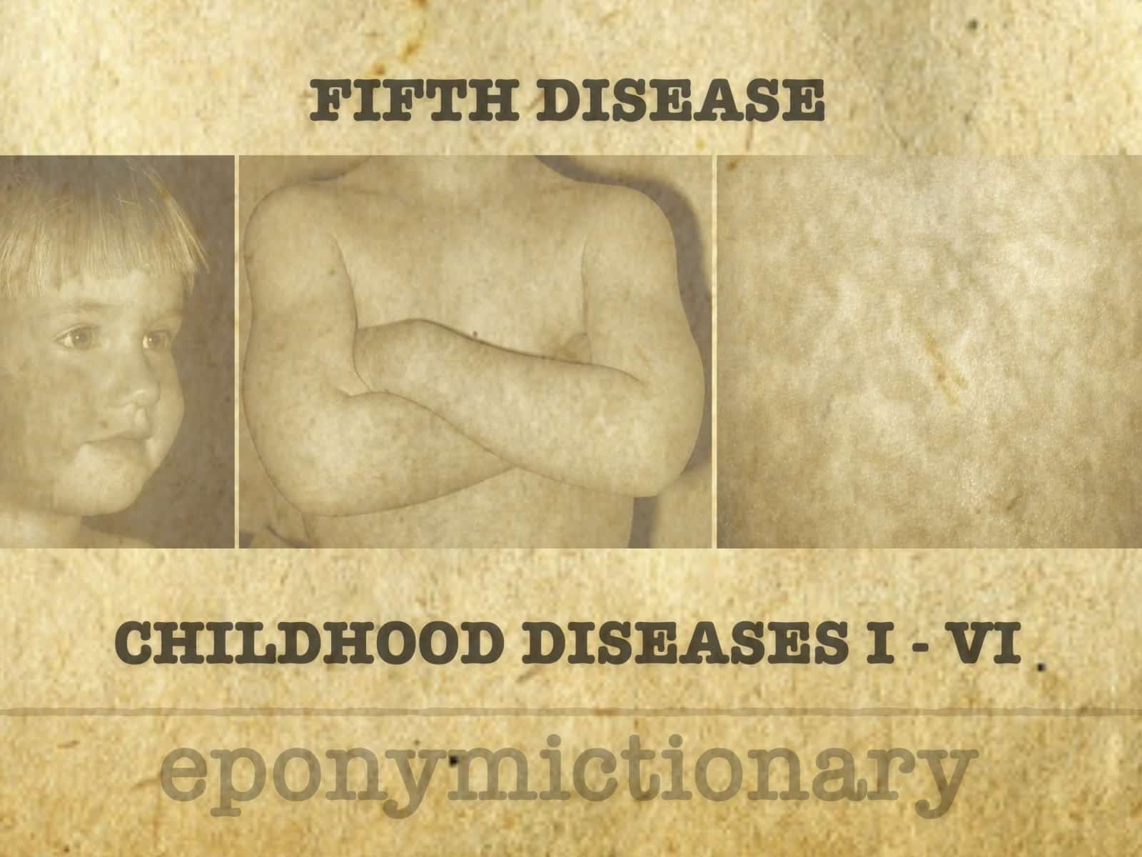 Fifths Disease Treatment