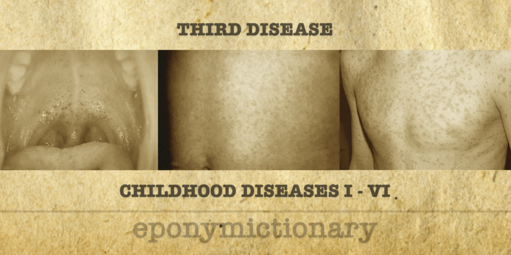 Third disease • LITFL • Medical Eponym Library