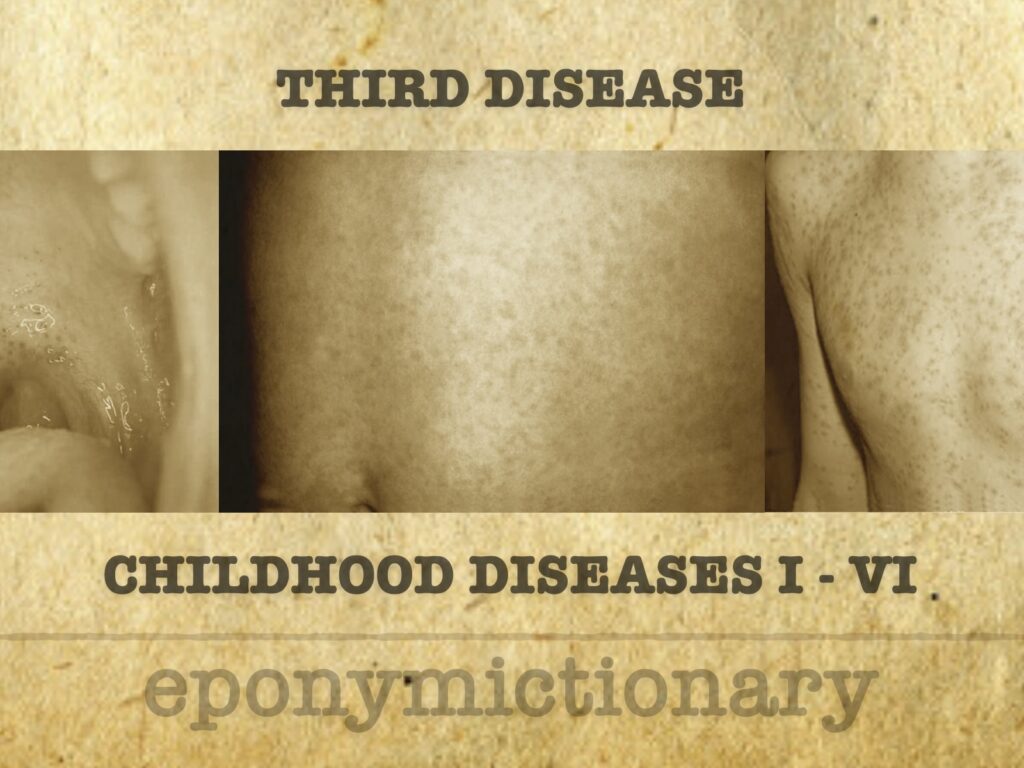 numbered diseases of childhood Archives • LITFL
