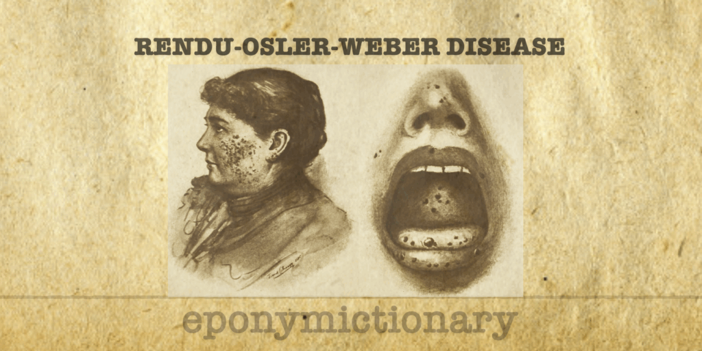Rendu-Osler-Weber disease • LITFL • Medical Eponym Library