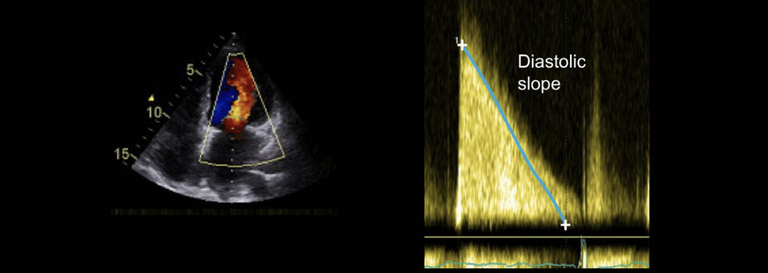 Echo basics: Measurements and Reports • LITFL • Radiology Library