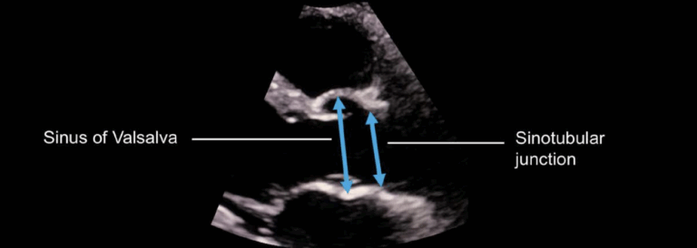 Echo basics: Prosthetic Valve • LITFL • Radiology Library