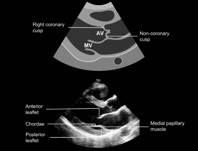 Echo basics: Valve Views • LITFL • Radiology Library