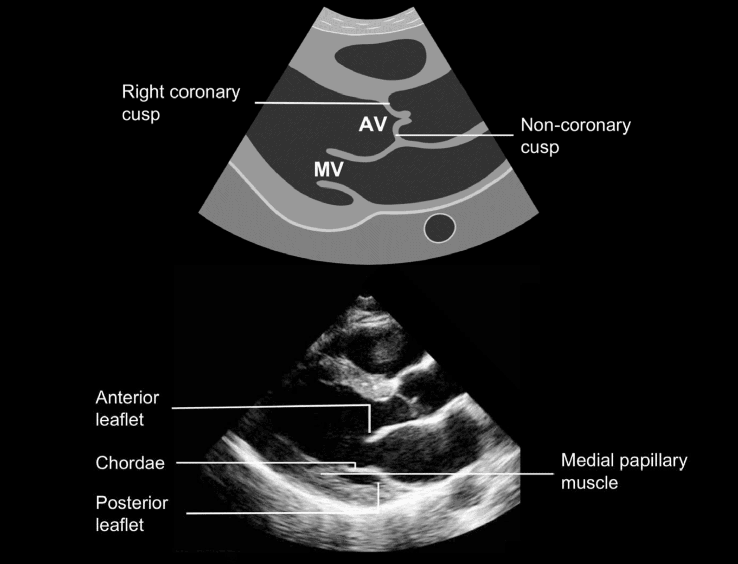 Echo Basics Valve Views LITFL Radiology Library Echo Basics Valve Views LITFL Radiology Library