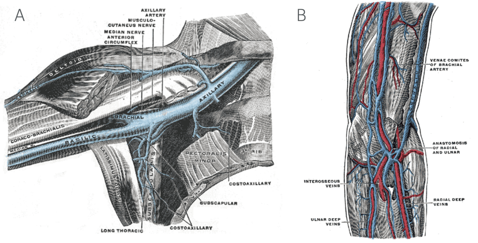 Axillary and subclavian vein thrombosis • LITFL • FFS