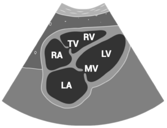 Echo basics: Apical and Subcostal Views • LITFL • Radiology Library