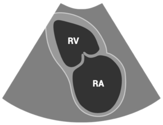 Echo basics: Parasternal Views • LITFL • Radiology Library
