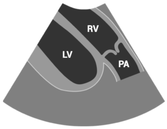 Echo basics: Parasternal Views • LITFL • Radiology Library